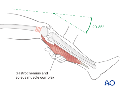Temporary long leg splint for Extraarticular fracture, avulsion
