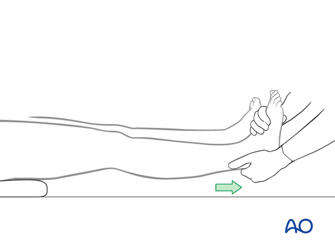 Temporary long leg splint for Extraarticular fracture, avulsion