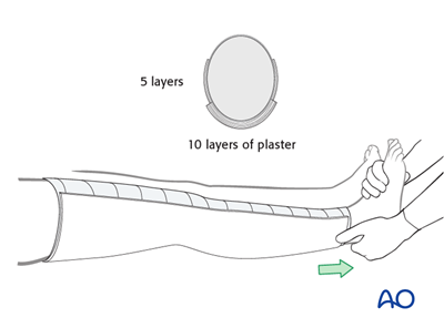Temporary long leg splint for Partial articular fracture, medial ...