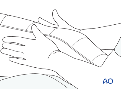 Temporary long leg splint for Extraarticular fracture, avulsion