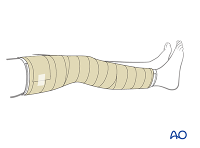Temporary long leg splint for Extraarticular fracture, avulsion