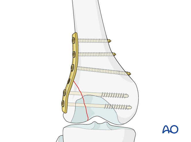 ORIF - Lag screws with or without buttress plate for Partial articular ...
