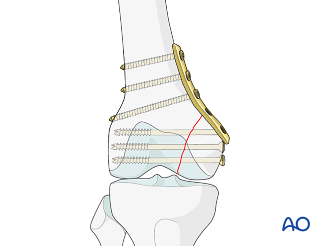ORIF - Lag screws with or without buttress plate for Partial articular ...