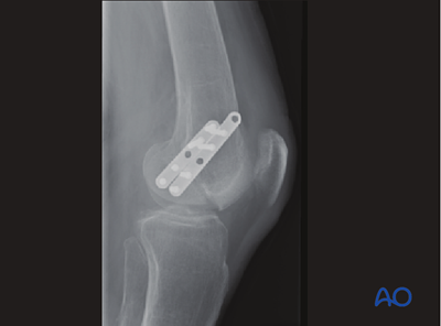 ORIF - Lag screw from posterior with or without plate for Partial ...