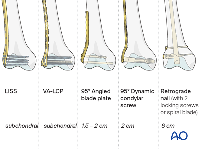 ORIF - Compression plate for Extraarticular fracture, simple