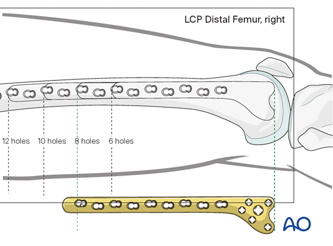 ORIF - Compression plate for Extraarticular fracture, simple