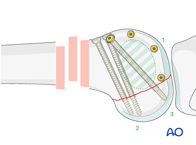 MIO - less invasive stabilization system (LISS)