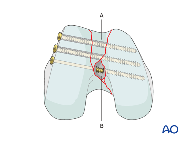MIO - less invasive stabilization system (LISS)