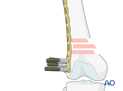 ORIF - Compression plate for Extraarticular fracture, simple
