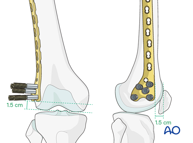 MIO – insertion of condylar locking compression plate (VA-LCP) as ...