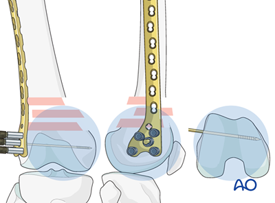 ORIF - Compression plate for Extraarticular fracture, simple