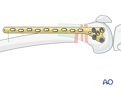 ORIF - Compression plate for Extraarticular fracture, simple