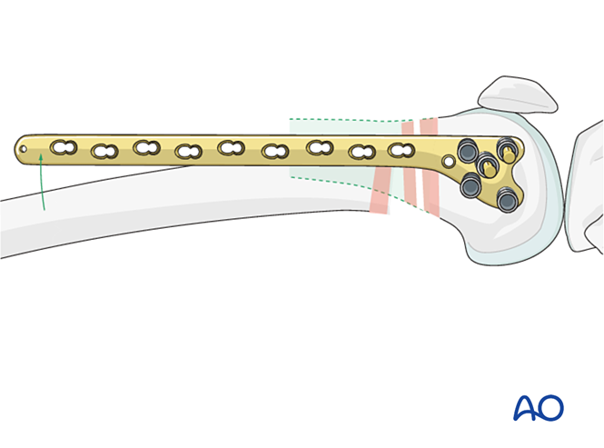 ORIF - Compression plate for Extraarticular fracture, simple