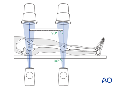 MIO - less invasive stabilization system (LISS)