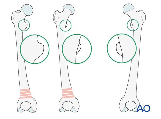 ORIF - Compression plate for Extraarticular fracture, simple