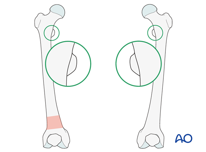 ORIF - Lag screw (epiphysis); MIO - Retrograde nailing for Complete ...