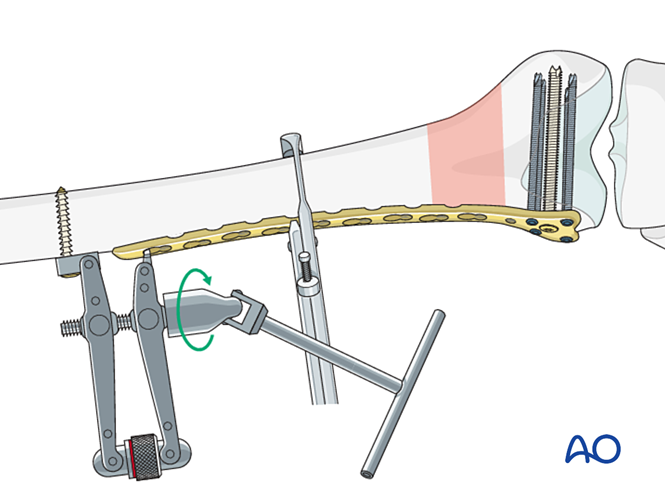 ORIF - Compression plate for Extraarticular fracture, simple