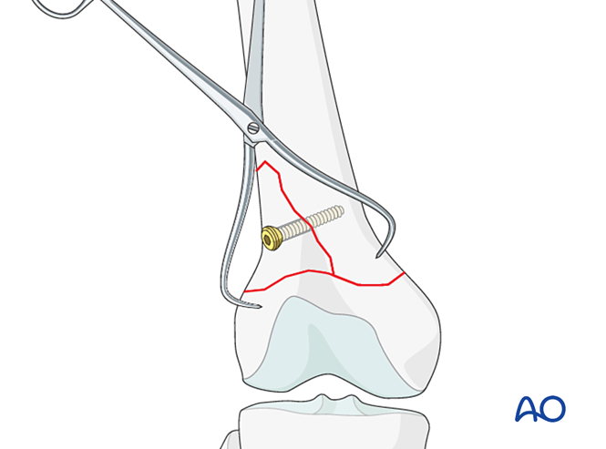 ORIF - Compression (or bridging) plate for Extraarticular fracture, wedge