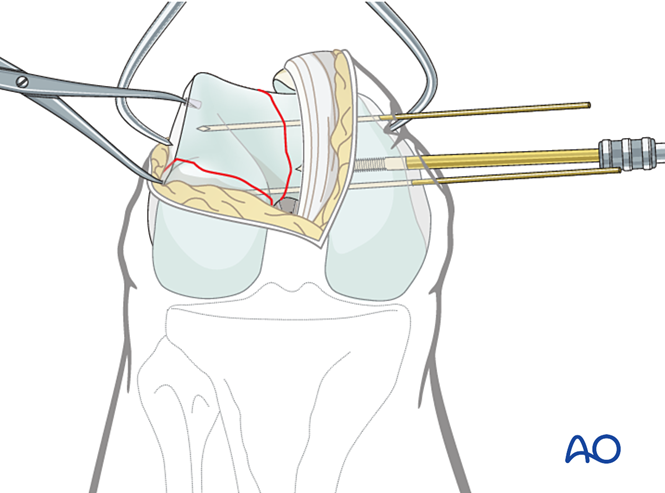 MIO - less invasive stabilization system (LISS)