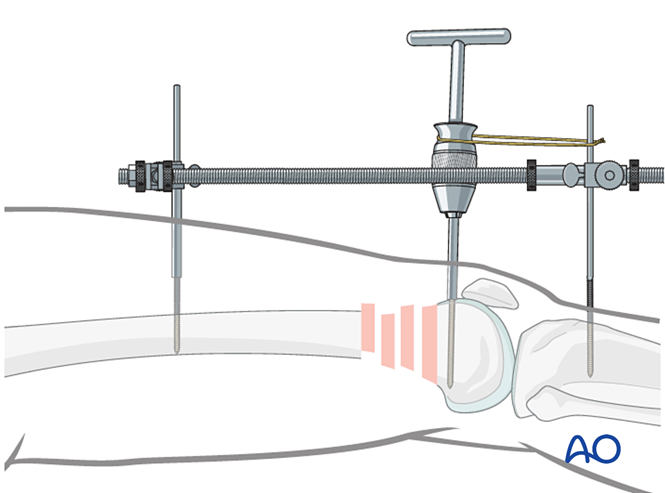 MIO - less invasive stabilization system (LISS)