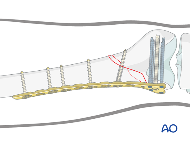 MIO - Compression plate for Extraarticular fracture, simple