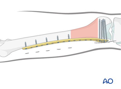 MIO - less invasive stabilization system (LISS)