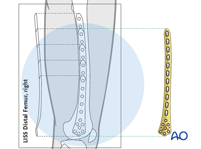 MIO - less invasive stabilization system (LISS)
