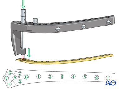 MIO - less invasive stabilization system (LISS)