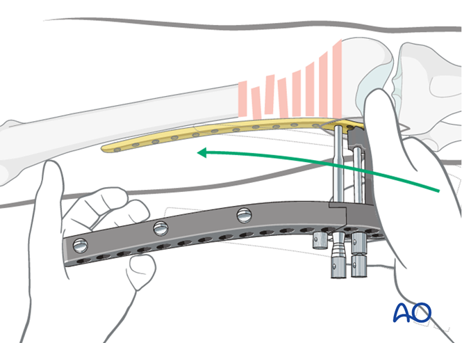 MIO - less invasive stabilization system (LISS)