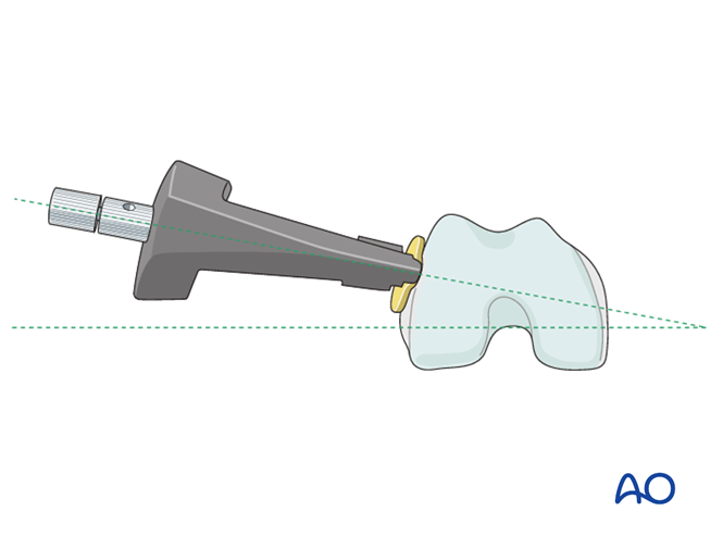 MIO - less invasive stabilization system (LISS)