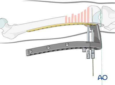 MIO - less invasive stabilization system (LISS)