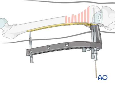 MIO - less invasive stabilization system (LISS)