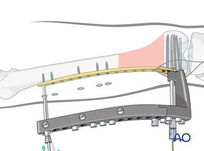 MIO - less invasive stabilization system (LISS)