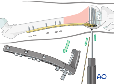 MIO - less invasive stabilization system (LISS)