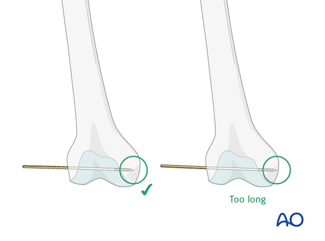 ORIF - dynamic condylar screw (DCS)