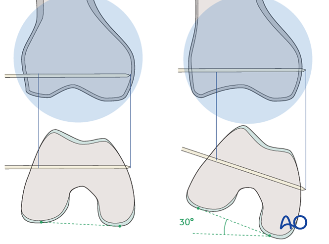 MIO - dynamic condylar screw system (DCS)