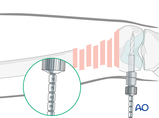 MIO - dynamic condylar screw system (DCS)