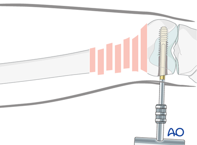 MIO - dynamic condylar screw system (DCS)