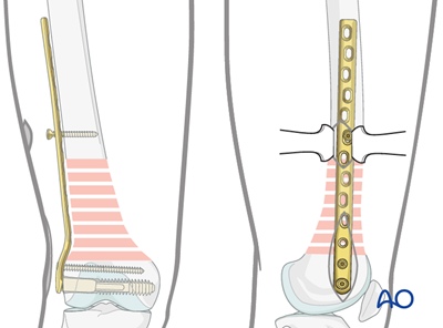 MIO - dynamic condylar screw system (DCS)