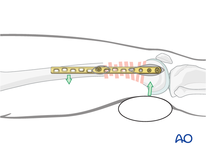 MIO - dynamic condylar screw system (DCS)