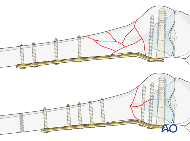 ORIF - dynamic condylar screw (DCS)