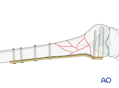 ORIF - dynamic condylar screw (DCS)