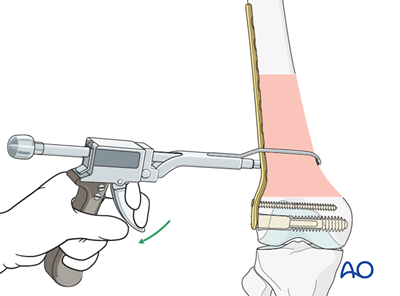 ORIF - dynamic condylar screw (DCS)