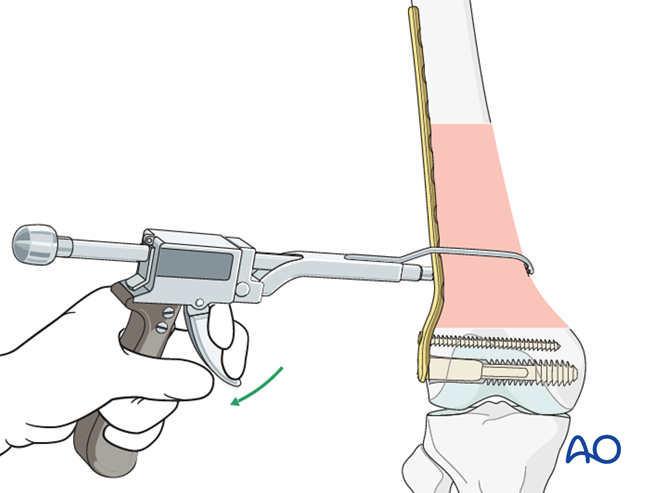 ORIF - dynamic condylar screw (DCS)
