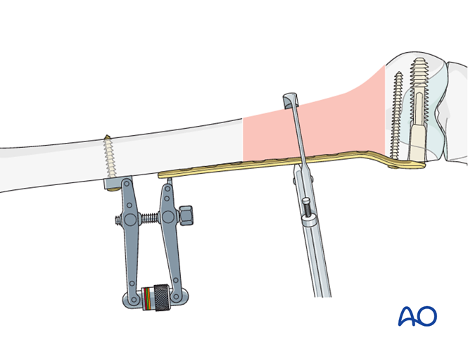 ORIF - dynamic condylar screw (DCS)