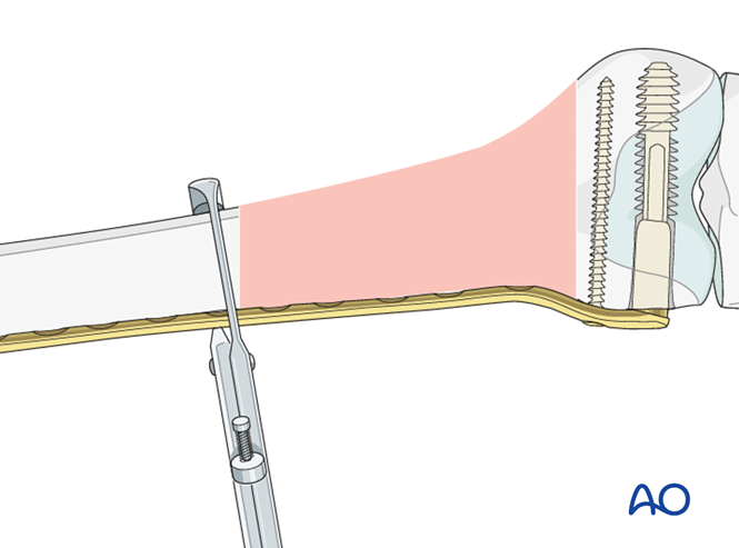 ORIF - dynamic condylar screw (DCS)
