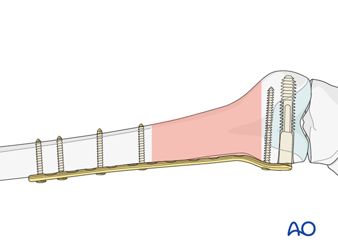 ORIF - dynamic condylar screw (DCS)