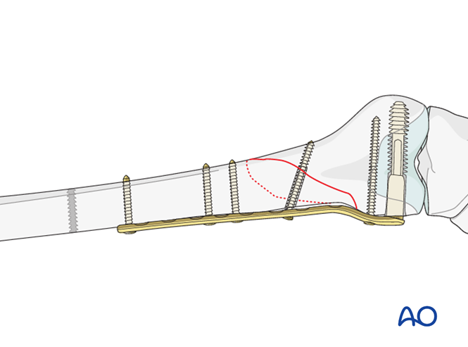 ORIF - dynamic condylar screw (DCS)