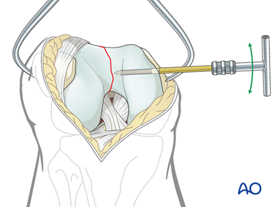 ORIF - Lag screw (epiphysis); MIO - Retrograde nailing for Complete ...