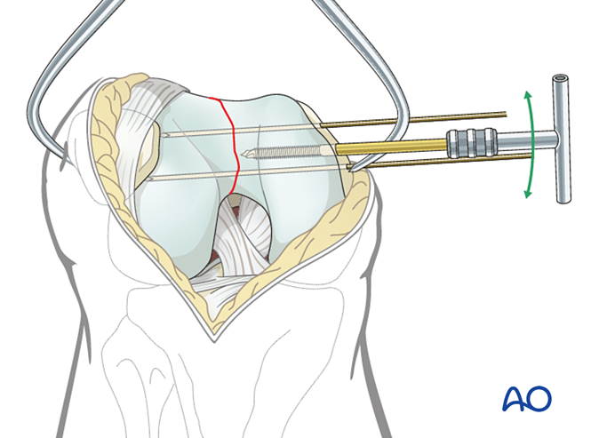ORIF - Lag screw (epiphysis); MIO - Retrograde nailing for Complete ...